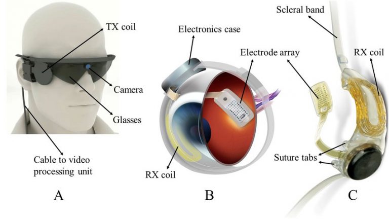 ARGUS-II-R-retinal-prosthesis-system-A-Wearable-external-unit-with-the ...